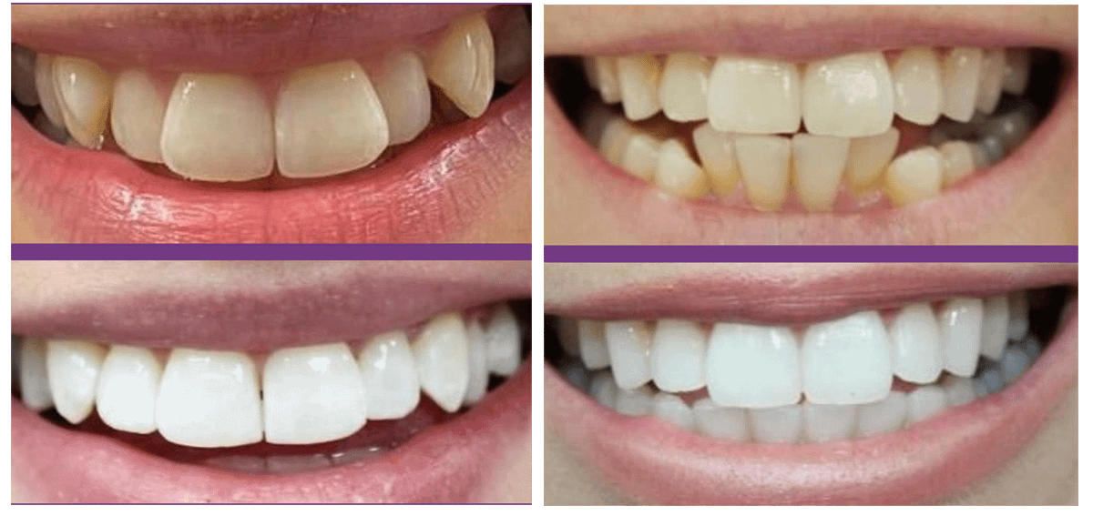 Invisalign - Rhodes Street Dental