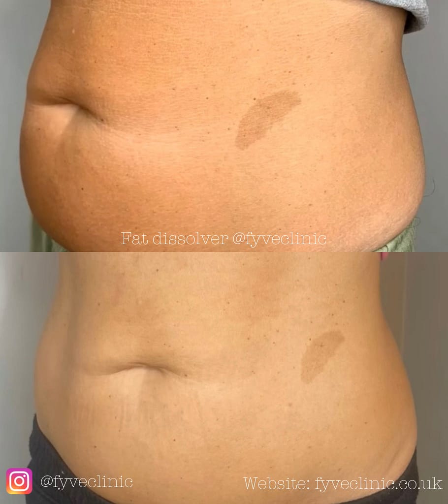 Exploring Lipo Lab Treatment Options in London - Savoy Aesthetics